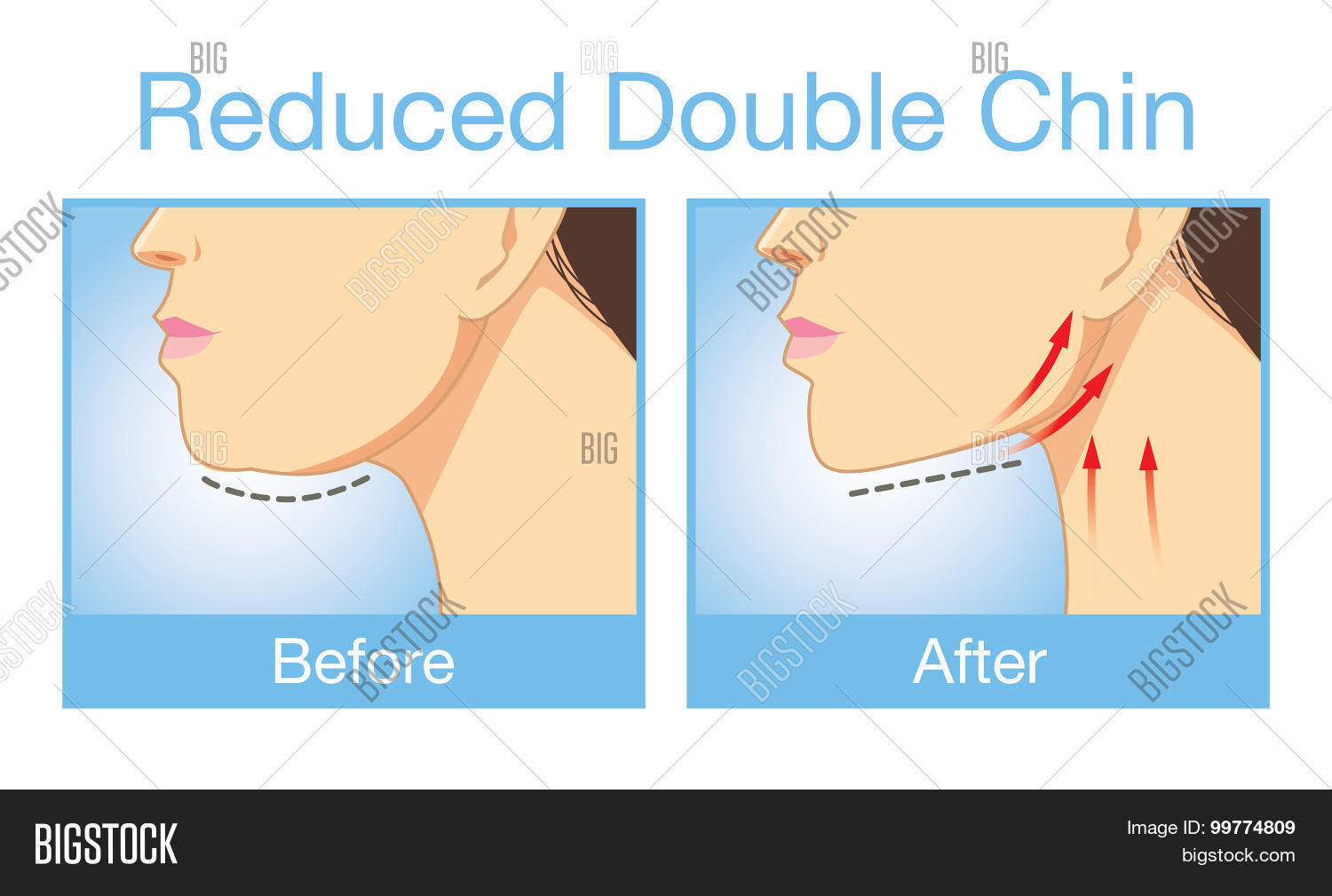 Reduce Double Chin Vector & Photo (Free Trial) | Bigstock
