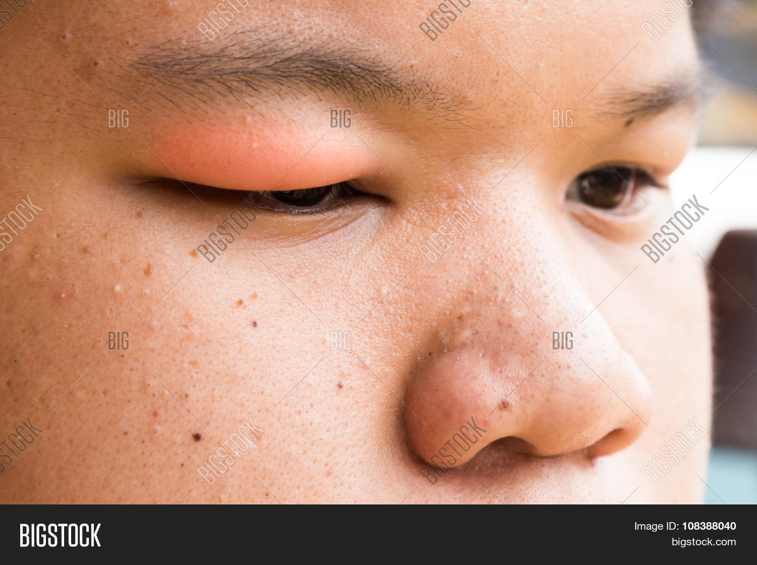 Swollen Red Upper Eye Image & Photo (Free Trial) | Bigstock