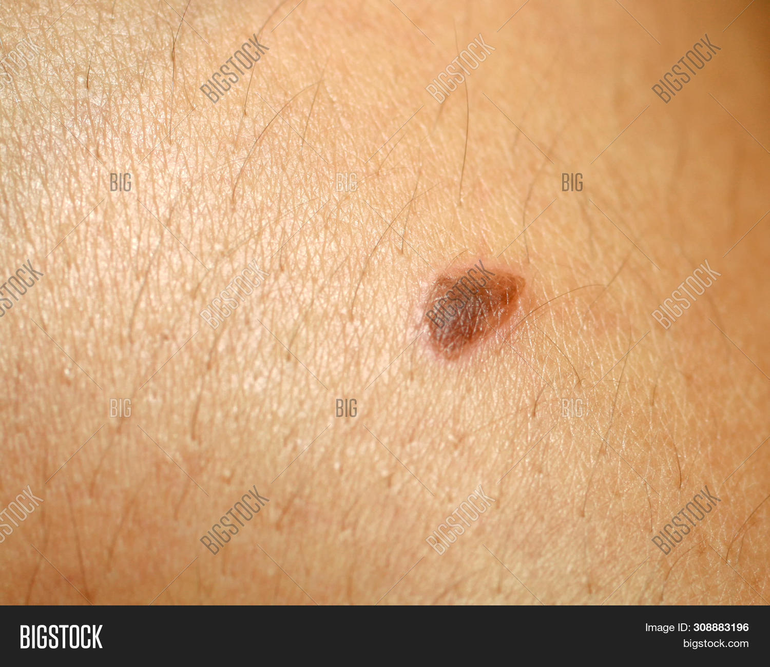 Burn On Skin. Blister Image & Photo (Free Trial) | Bigstock
