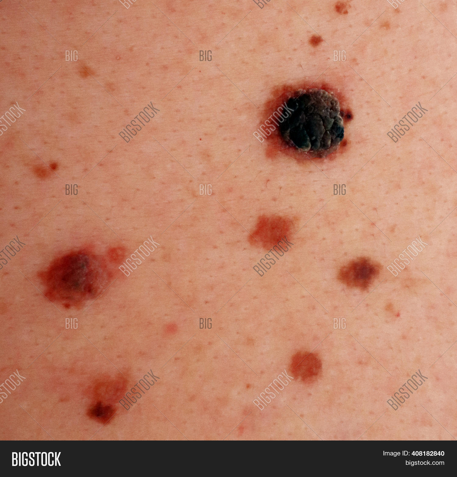 Mole Freckles On Back Image & Photo (Free Trial) | Bigstock