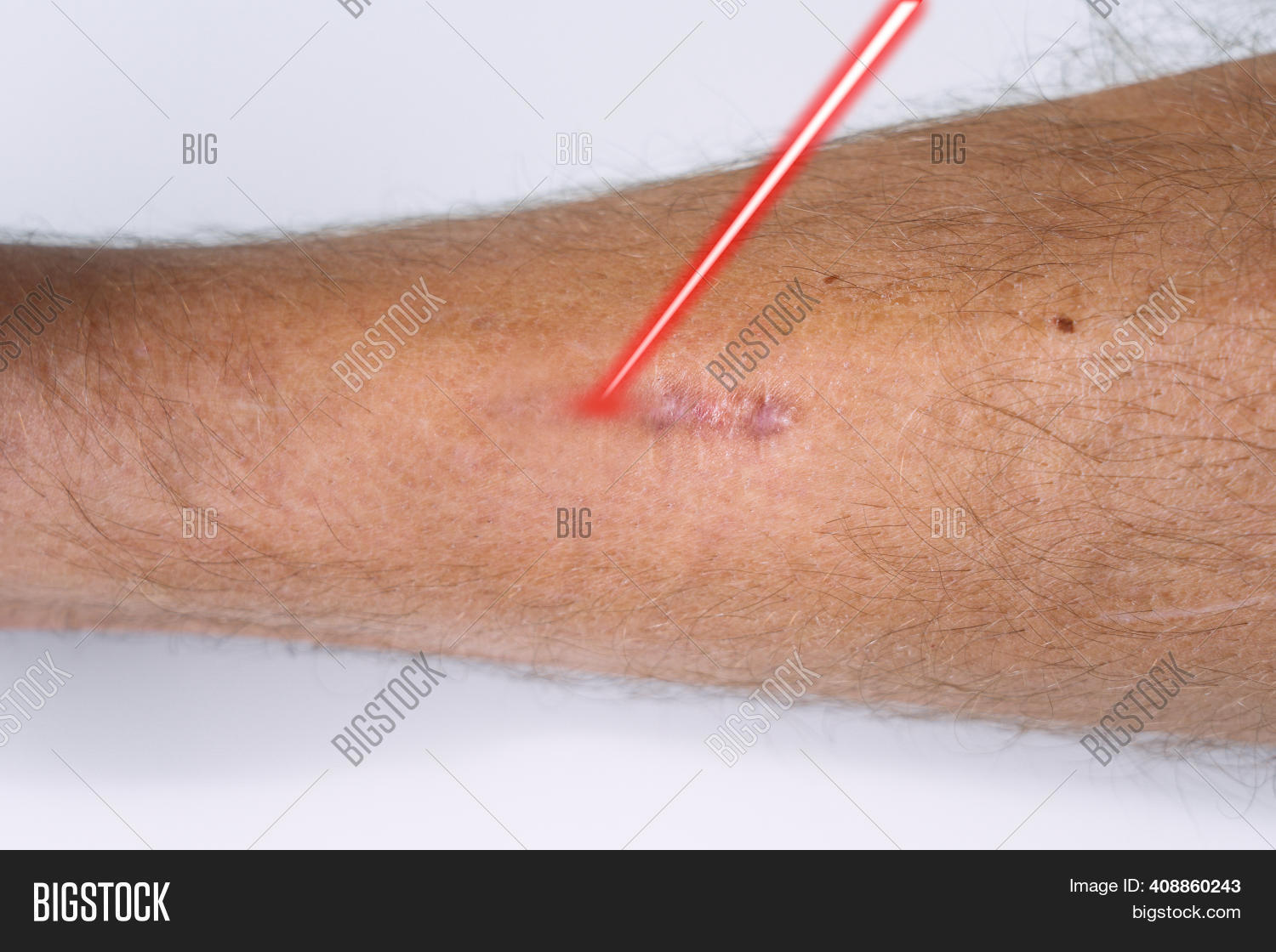 Mans Leg Scar Laser Image & Photo (Free Trial) | Bigstock