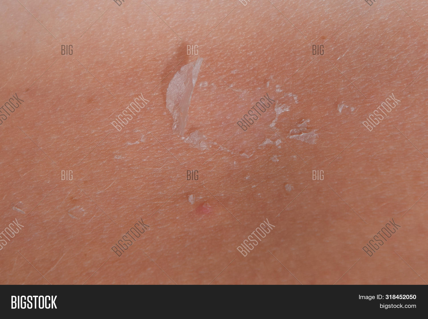 Sunburn On Skin Back Image And Photo Free Trial Bigstock