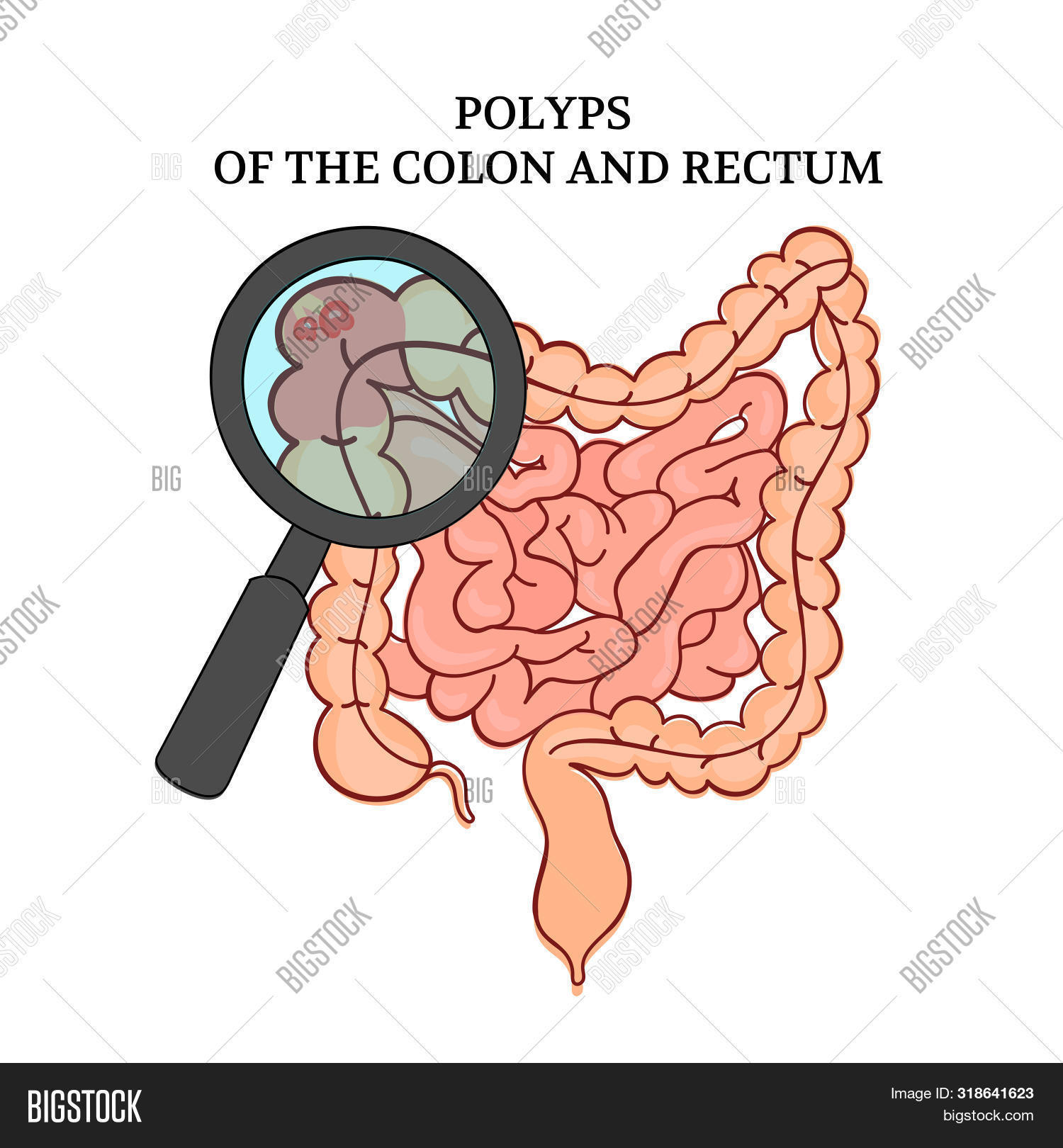 Polyps Colon Vector & Photo (Free Trial) | Bigstock