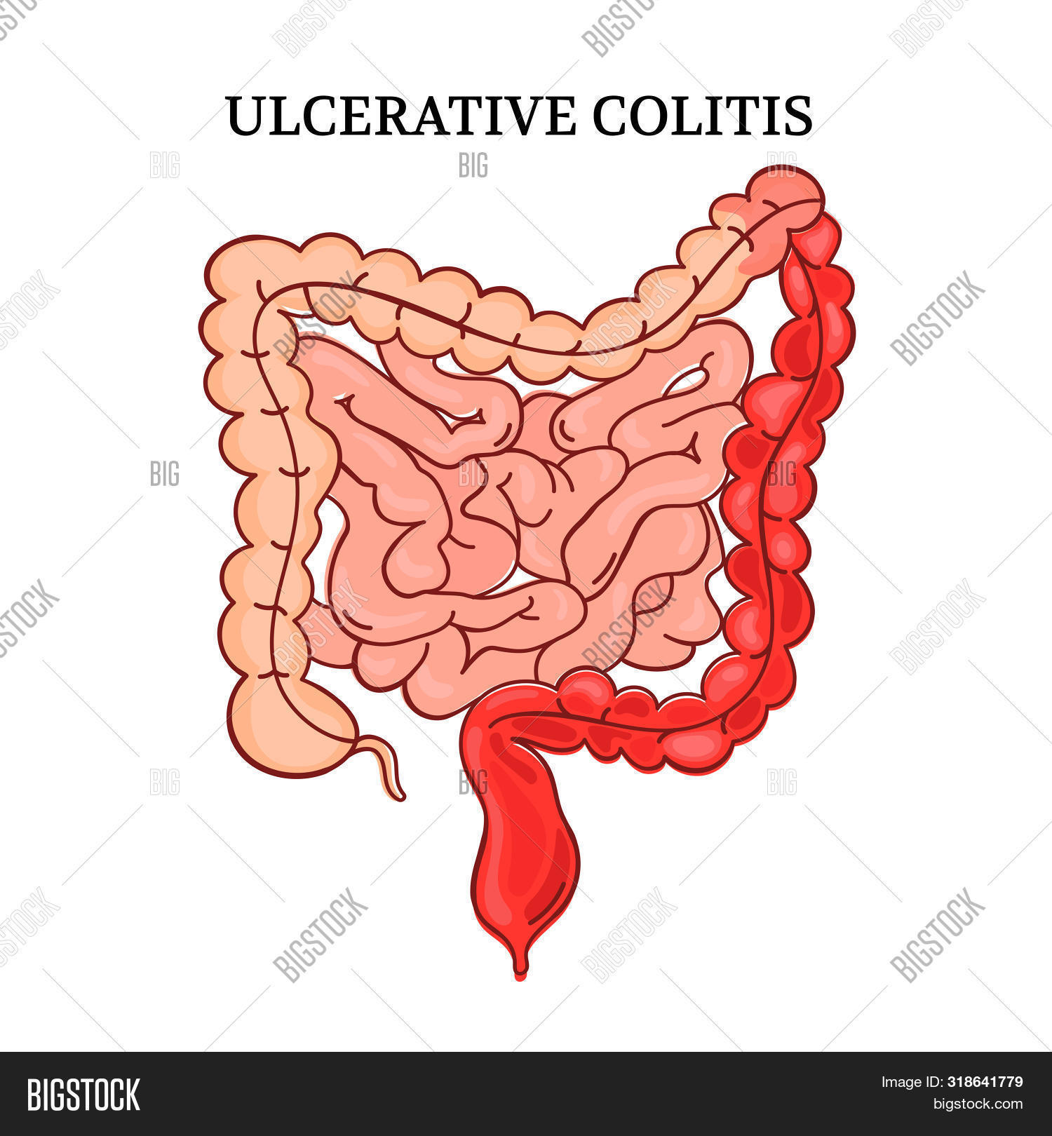 Ulcerative Colitis Vector & Photo (Free Trial) | Bigstock