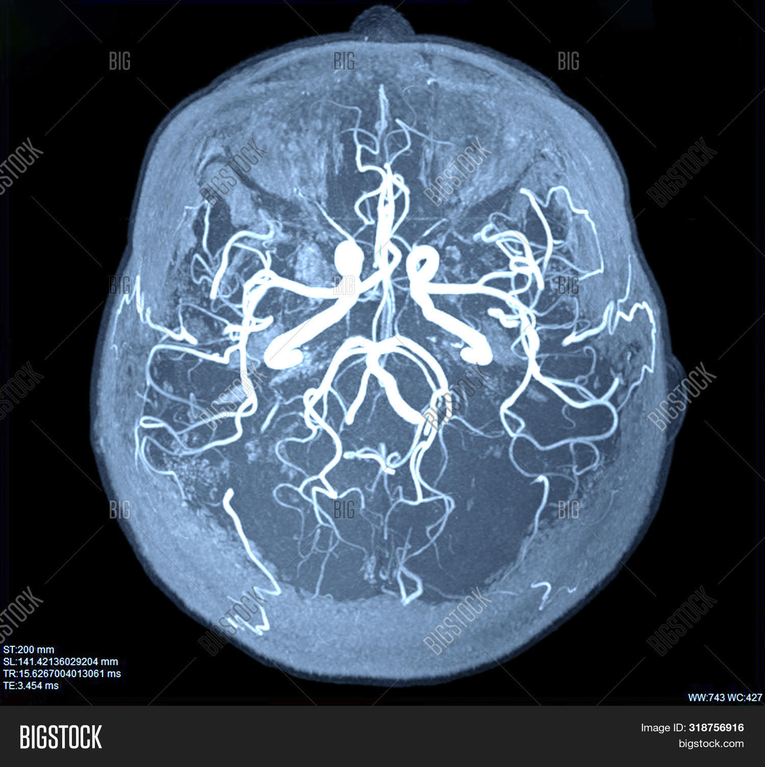 Mri Blood Vessels Image & Photo (Free Trial) | Bigstock