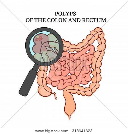 Polyps Colon Vector & Photo (Free Trial) | Bigstock