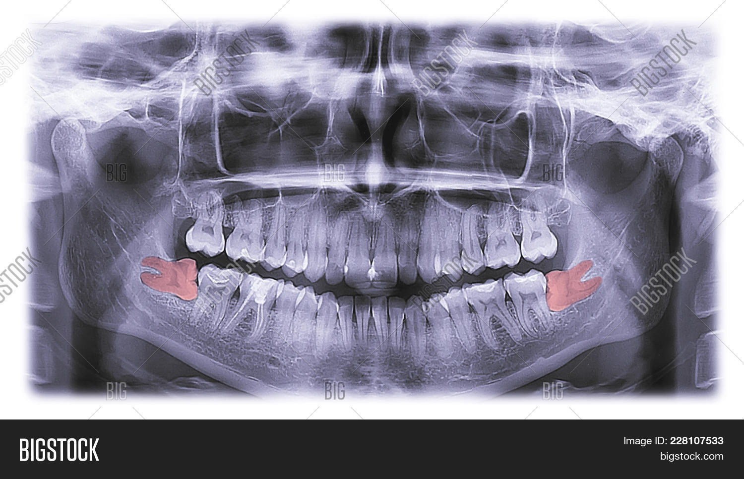 X-ray Teeth, Molar Image & Photo (Free Trial) | Bigstock