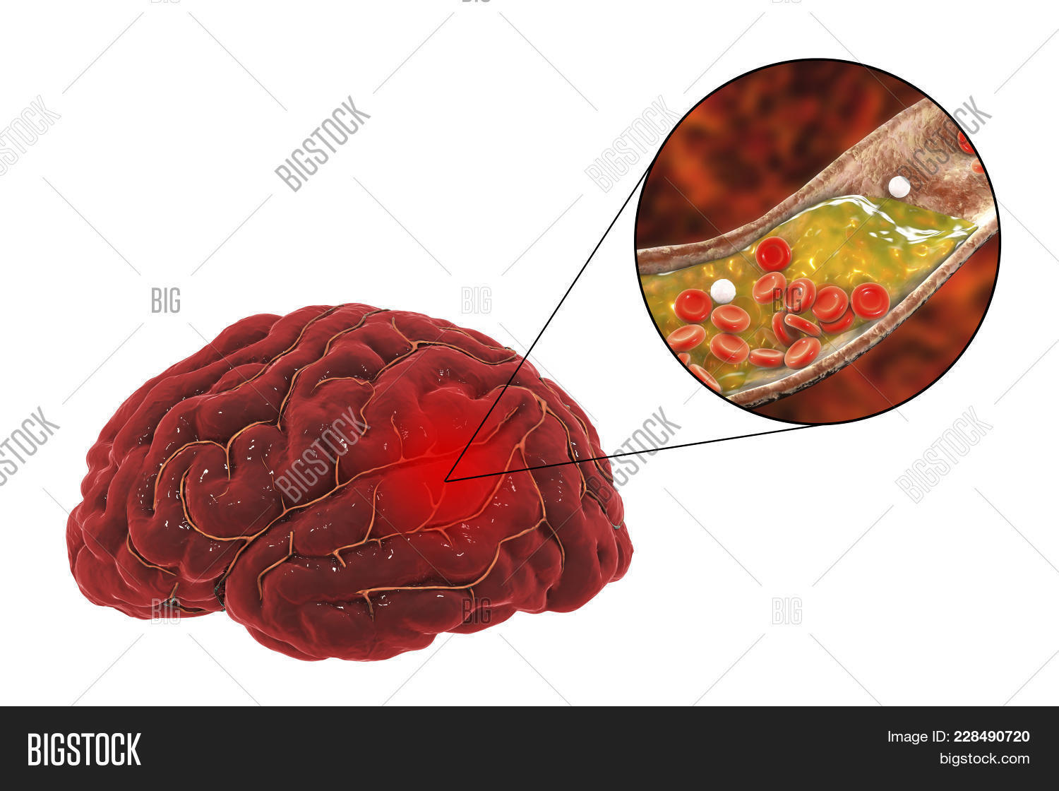 Ischemic Brain Stroke Image & Photo (Free Trial) | Bigstock