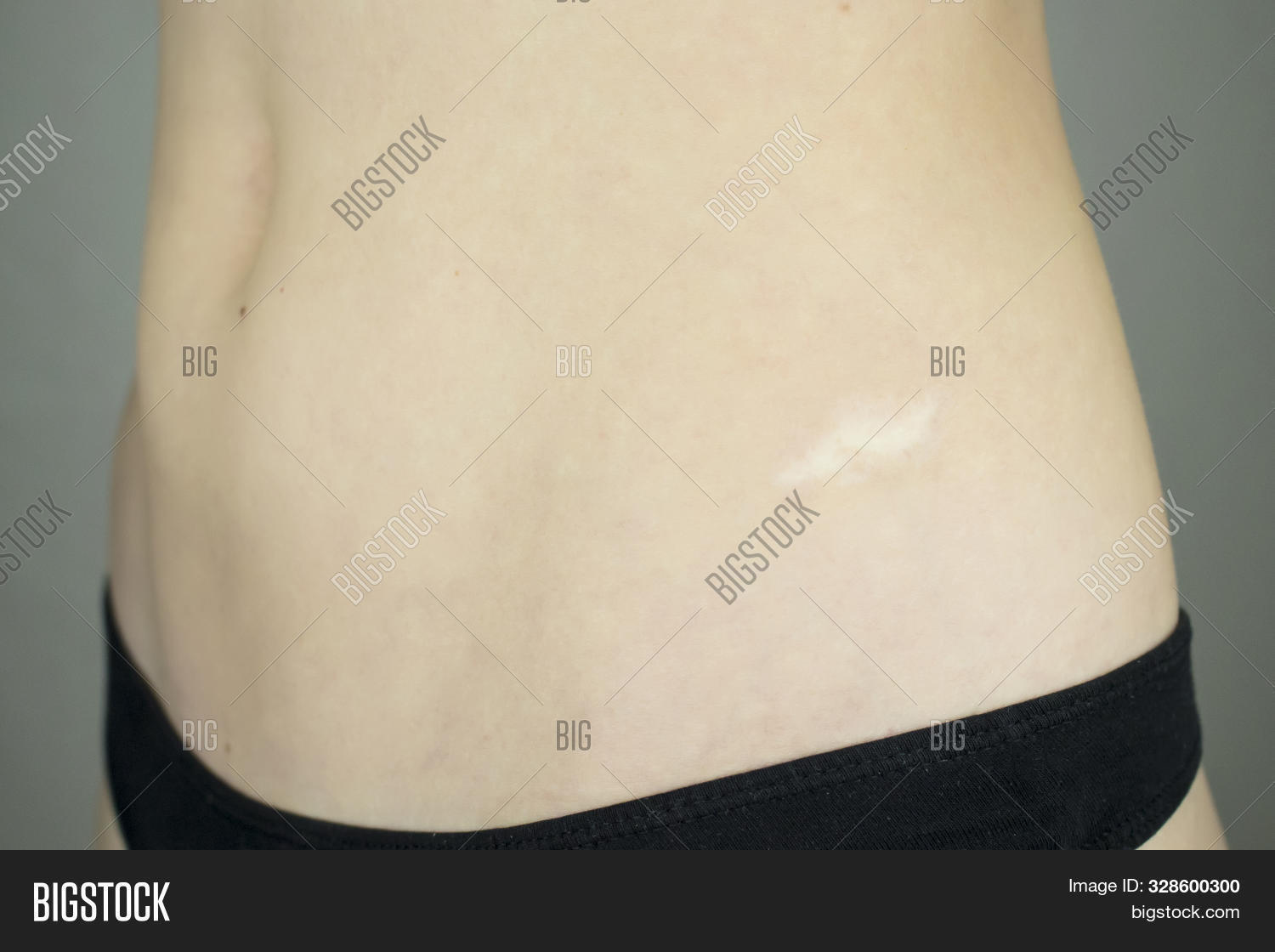 Belly Girl Scar On Her Image & Photo (Free Trial) | Bigstock