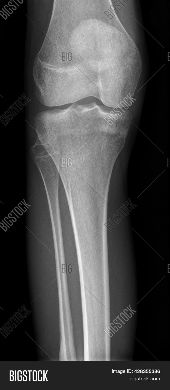 Rx Tibia Fibula. Front Image & Photo (Free Trial) | Bigstock