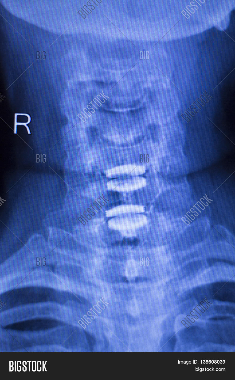 Neck Spine Injury Xray Image & Photo (Free Trial) | Bigstock