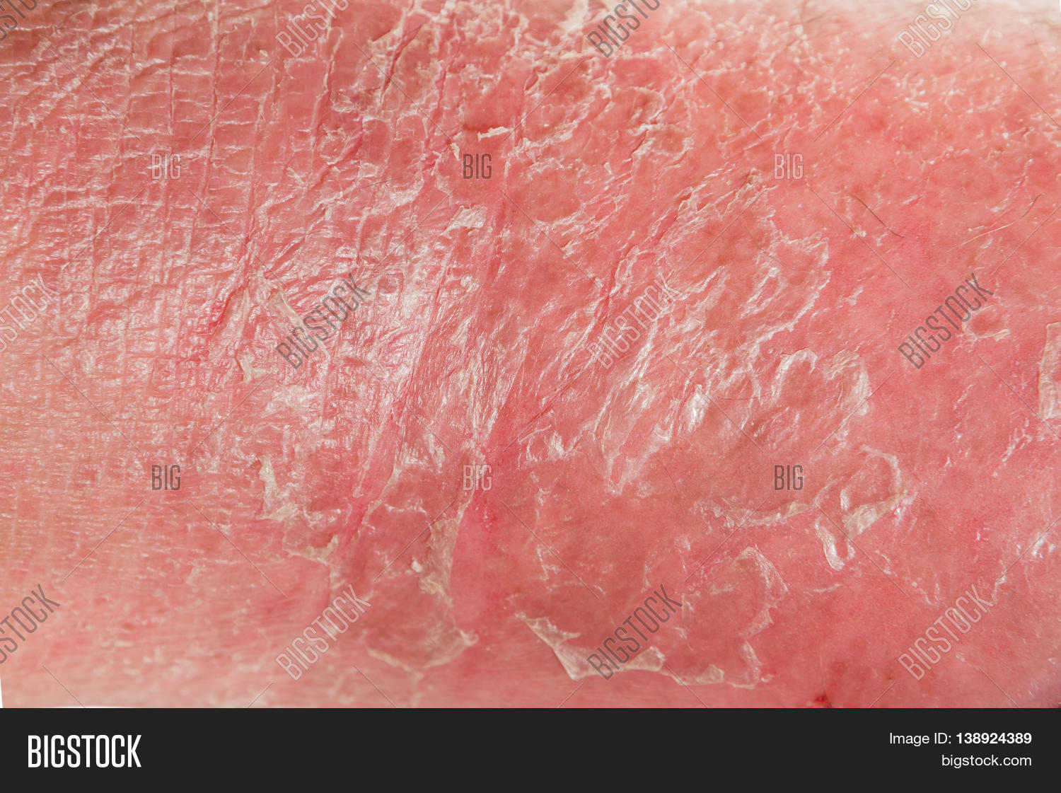 Psoriasis Skin Image & Photo (Free Trial) | Bigstock
