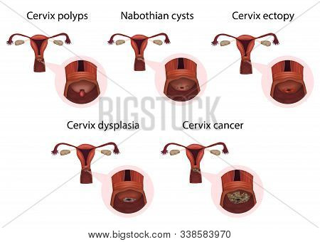 Cervical Diseases. Image & Photo (Free Trial) | Bigstock