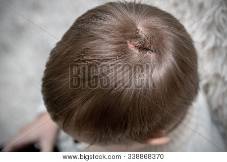 Lacerations Wound Head Image & Photo (Free Trial) | Bigstock