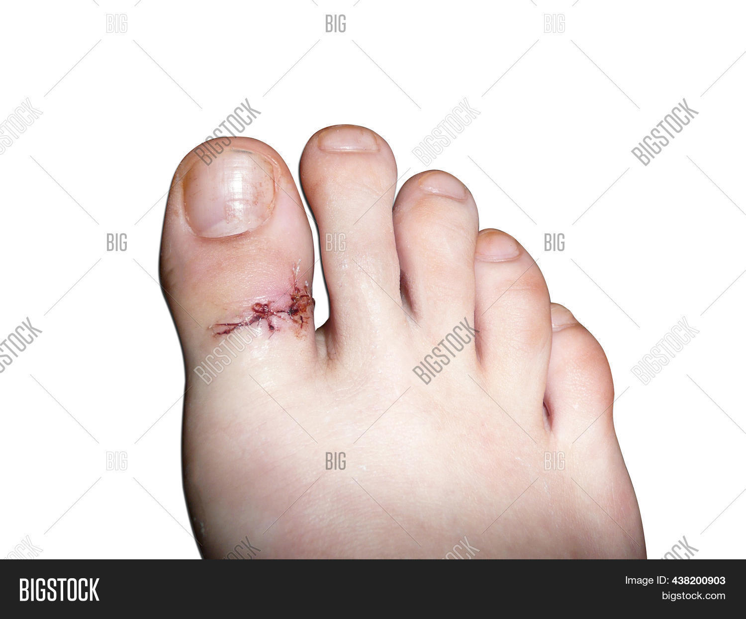Surgical Suture On Big Image & Photo (Free Trial) | Bigstock