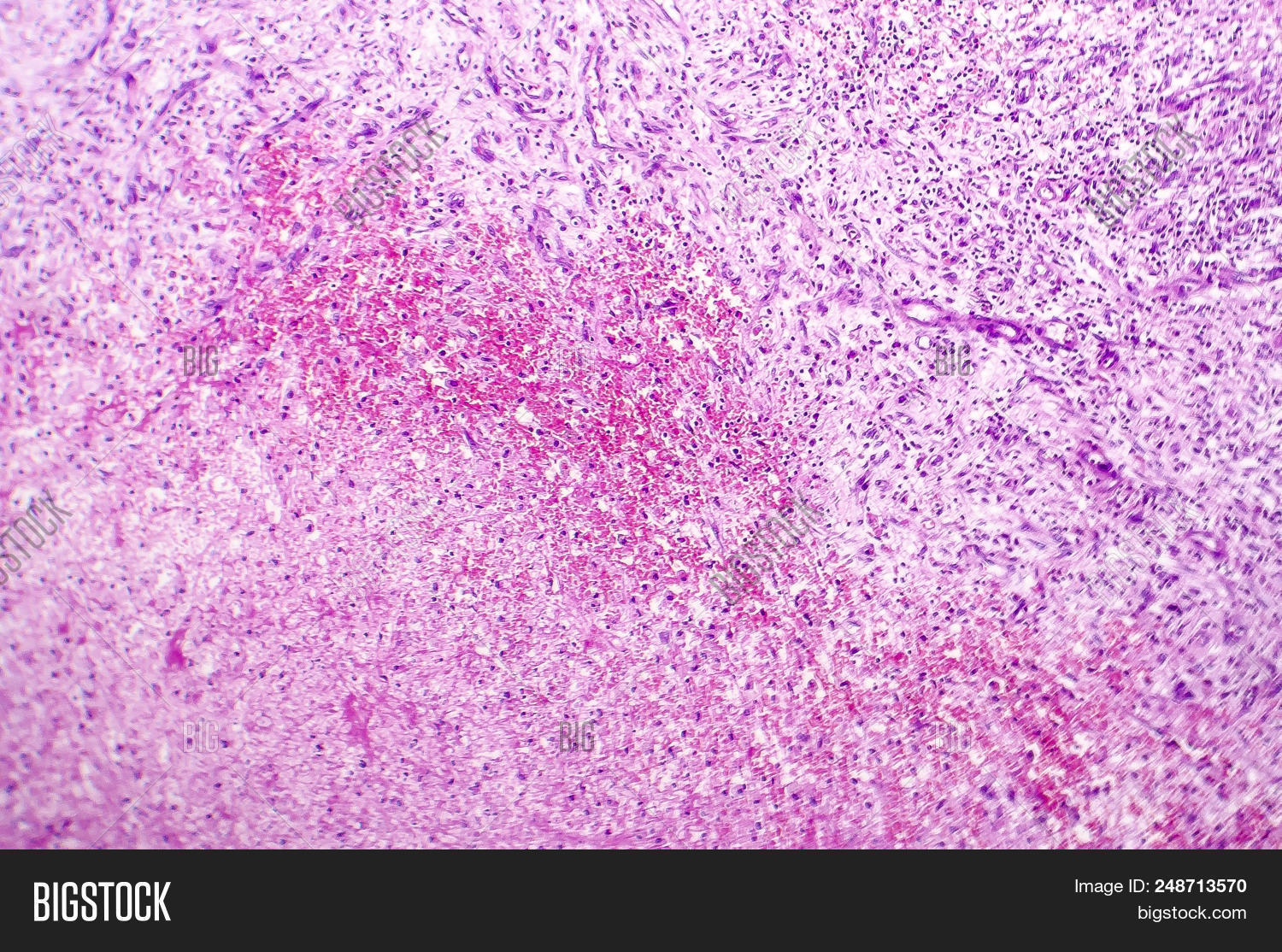 Splenic Infarction, Image & Photo (Free Trial) | Bigstock