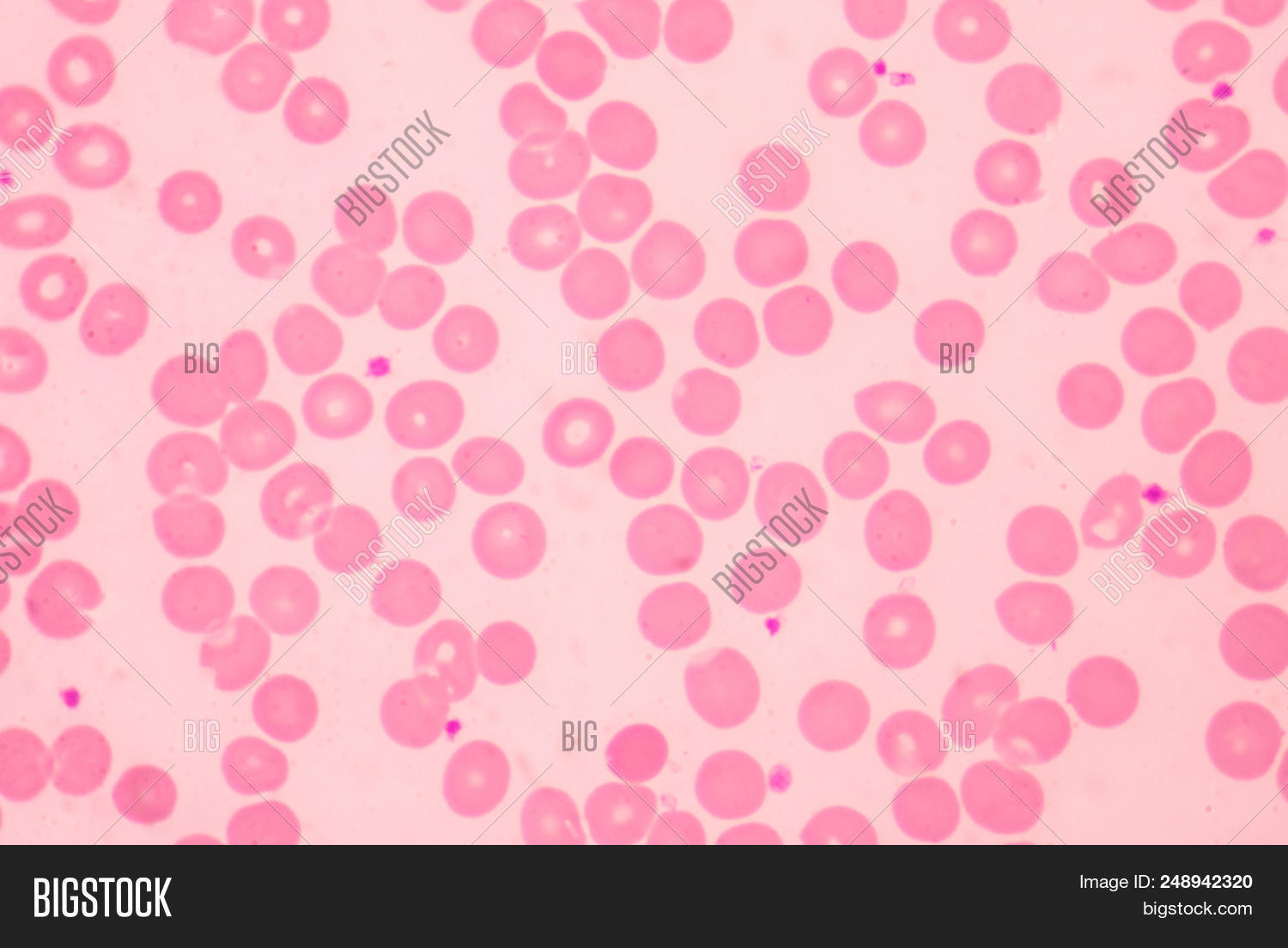 Normochromic Nomocytic Image & Photo (Free Trial) | Bigstock