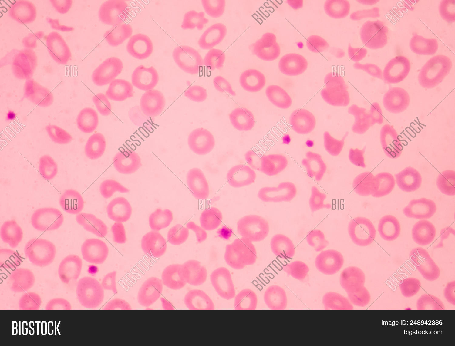 Thalassemia Blood Image & Photo (Free Trial) | Bigstock