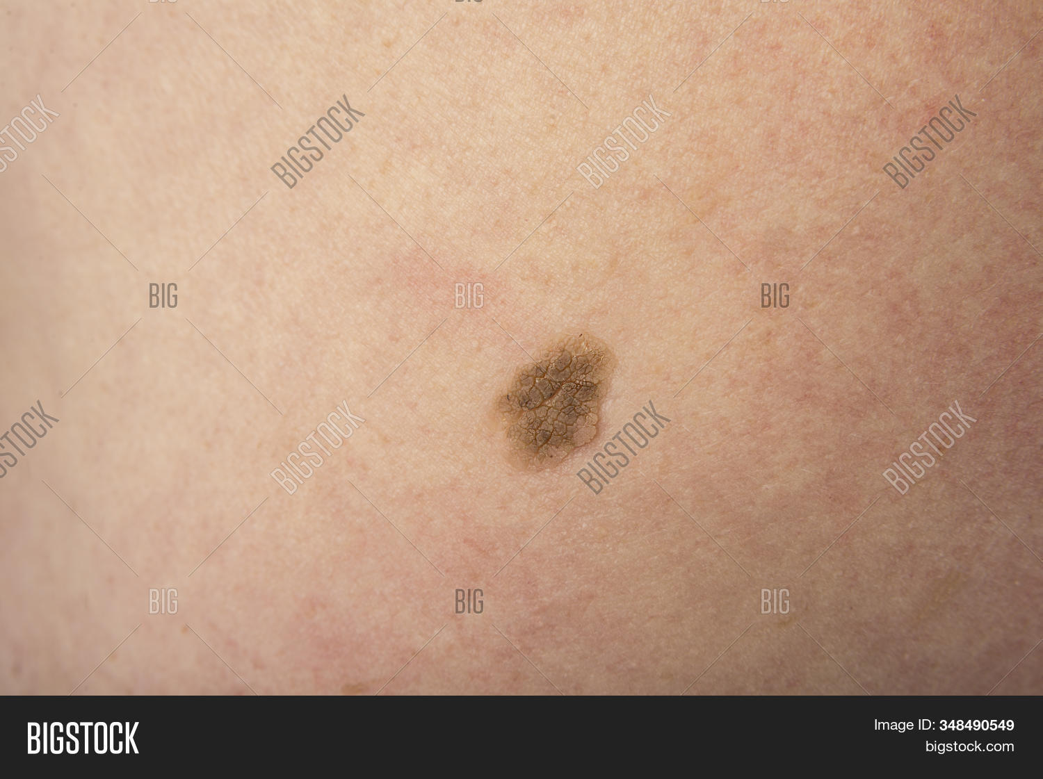 Human Skin Wart On Image & Photo (Free Trial) | Bigstock