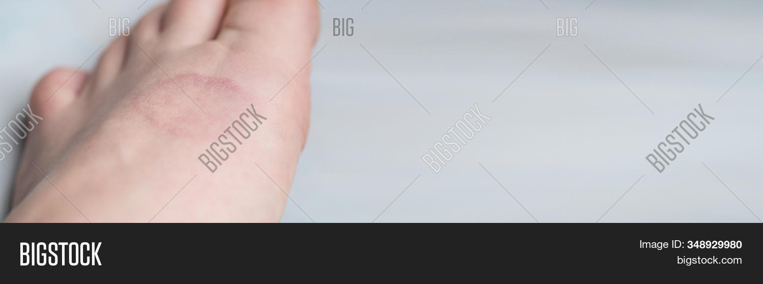 Human Leg Granuloma Image & Photo (Free Trial) | Bigstock