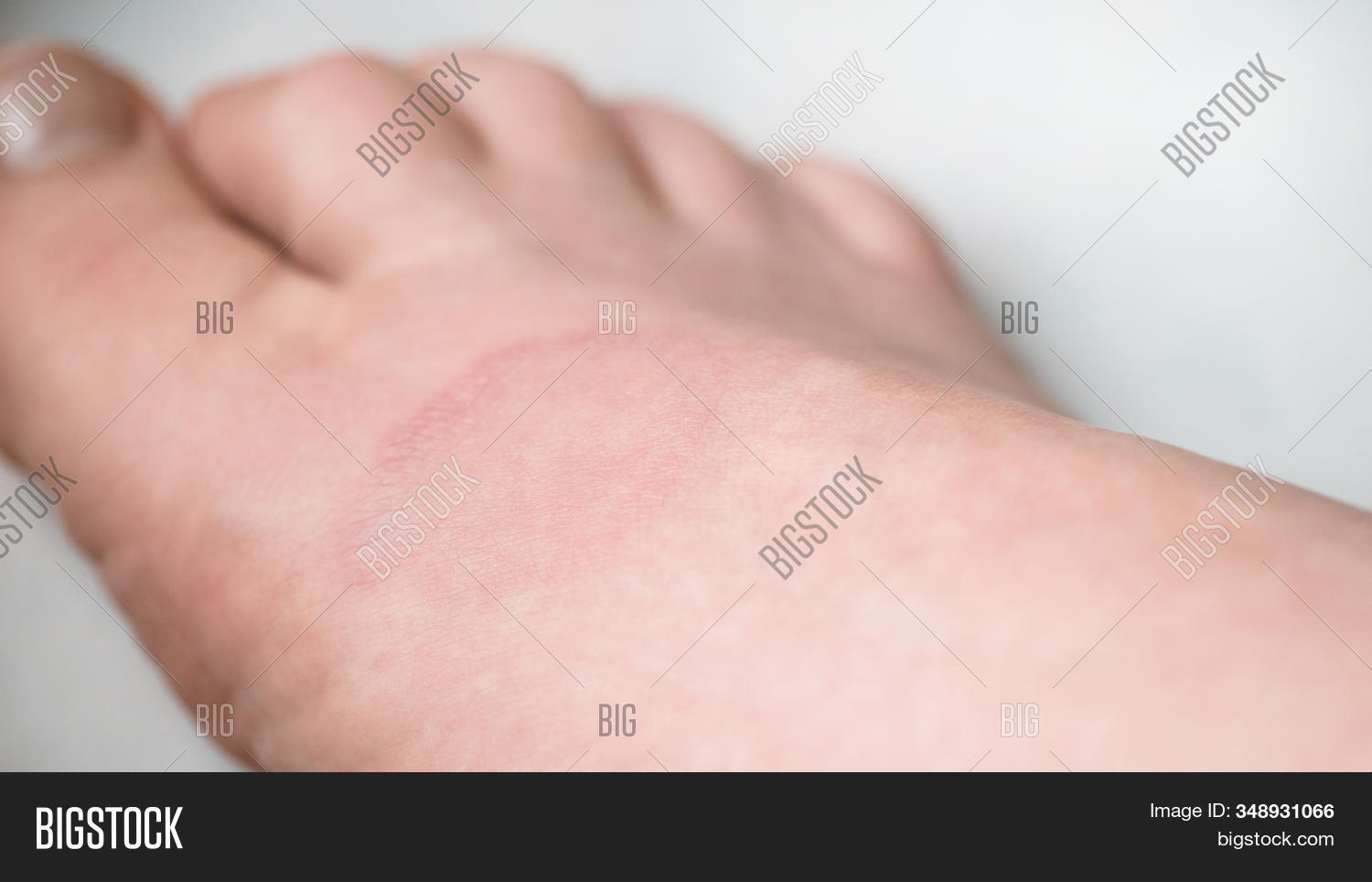 Human Leg Granuloma Image & Photo (Free Trial) | Bigstock
