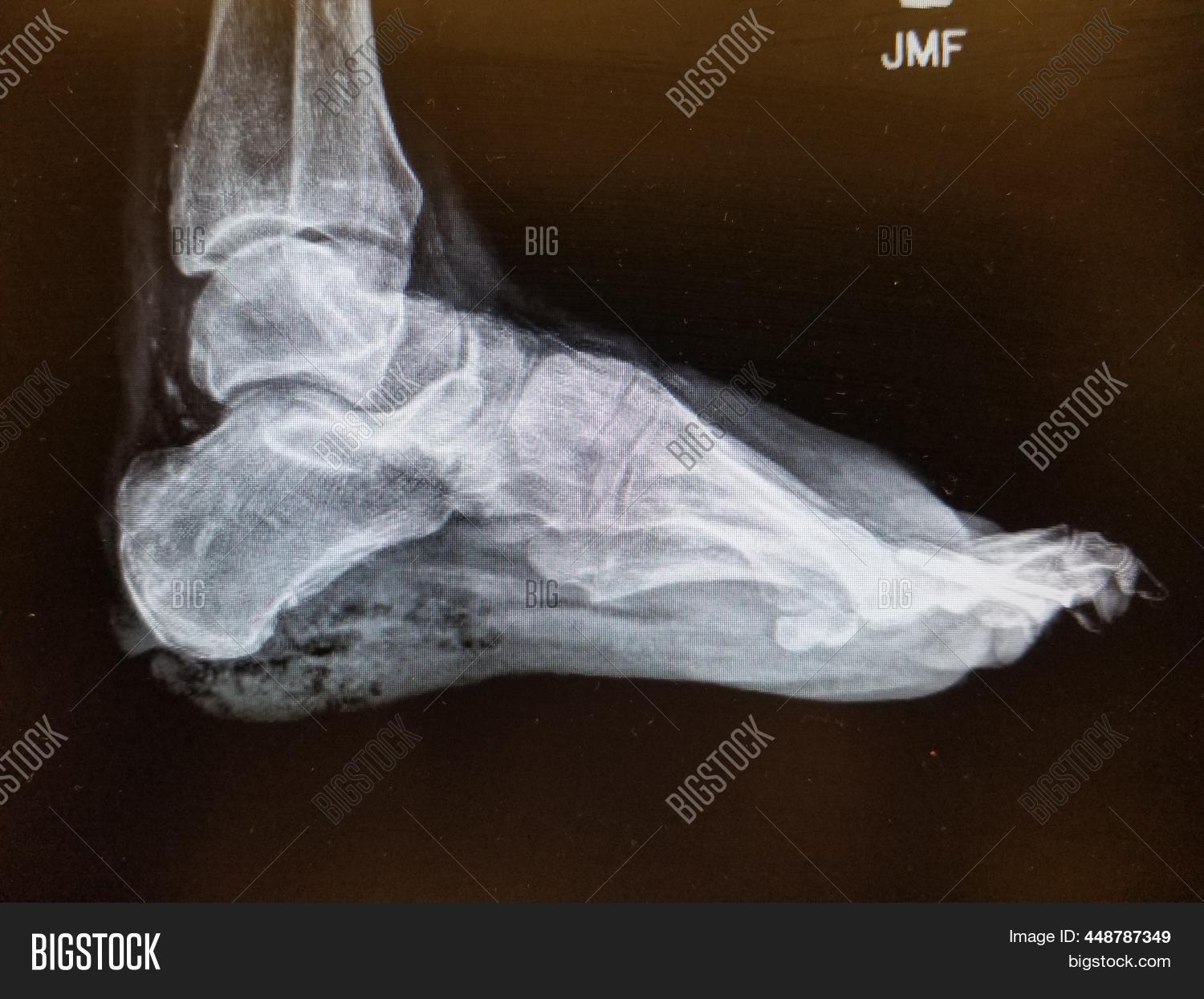 Gas Gangrene - Image & Photo (Free Trial) | Bigstock