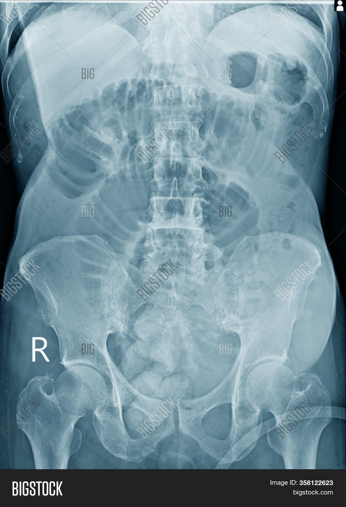 X- Ray Whole Abdomen, Image & Photo (Free Trial) | Bigstock