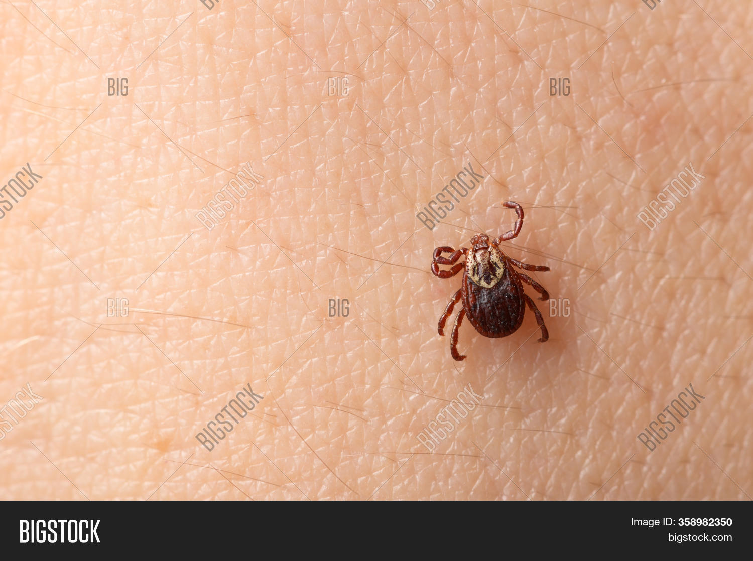 Tick On Skin Person Image & Photo (Free Trial) | Bigstock