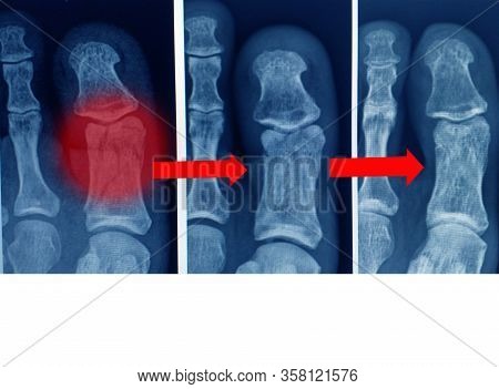 X-ray Fracture Big Toe Image & Photo (Free Trial) | Bigstock