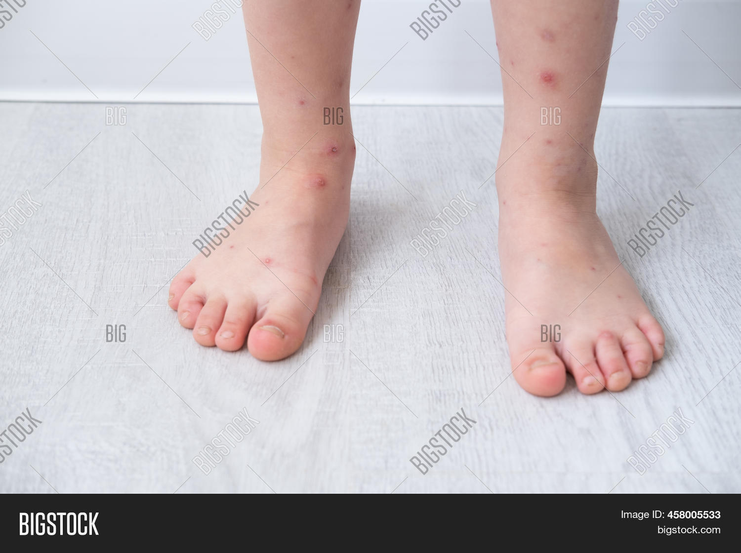 Chickenpox Disease, Image & Photo (Free Trial) | Bigstock