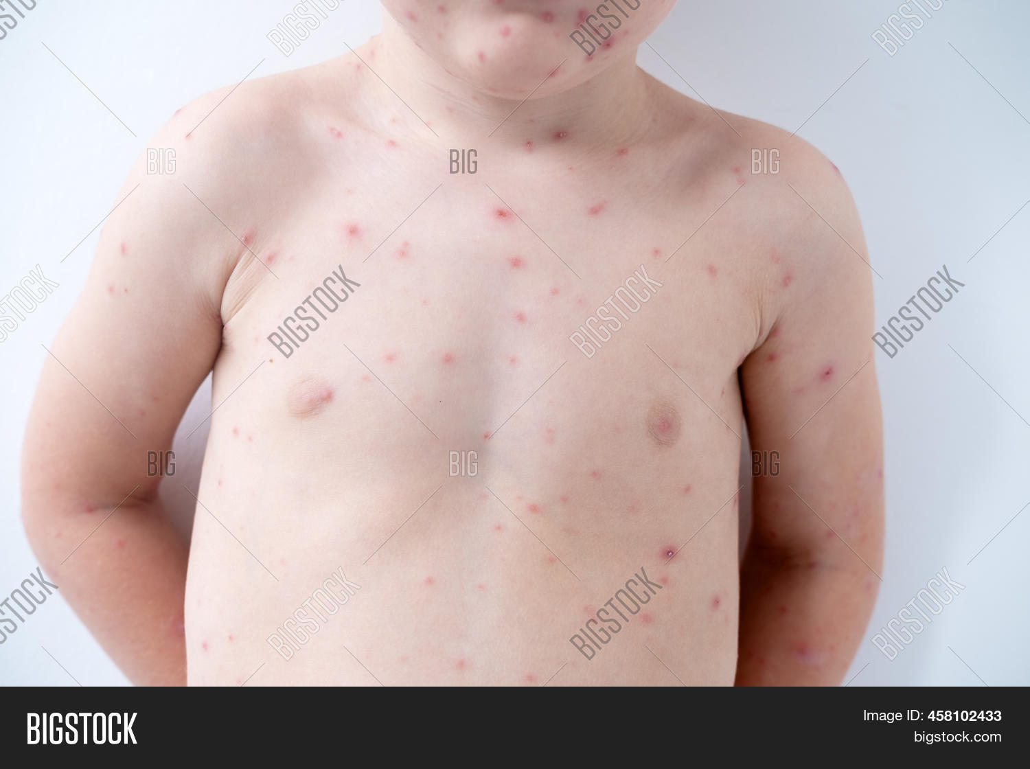 Chickenpox Disease, Image & Photo (Free Trial) | Bigstock