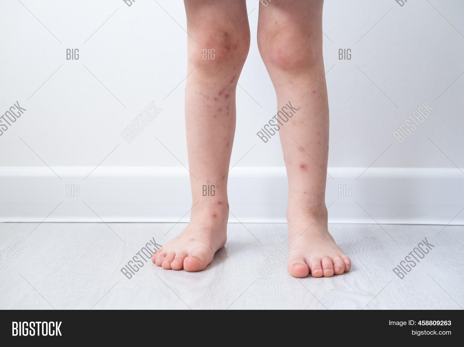 Chickenpox Disease, Image & Photo (Free Trial) | Bigstock