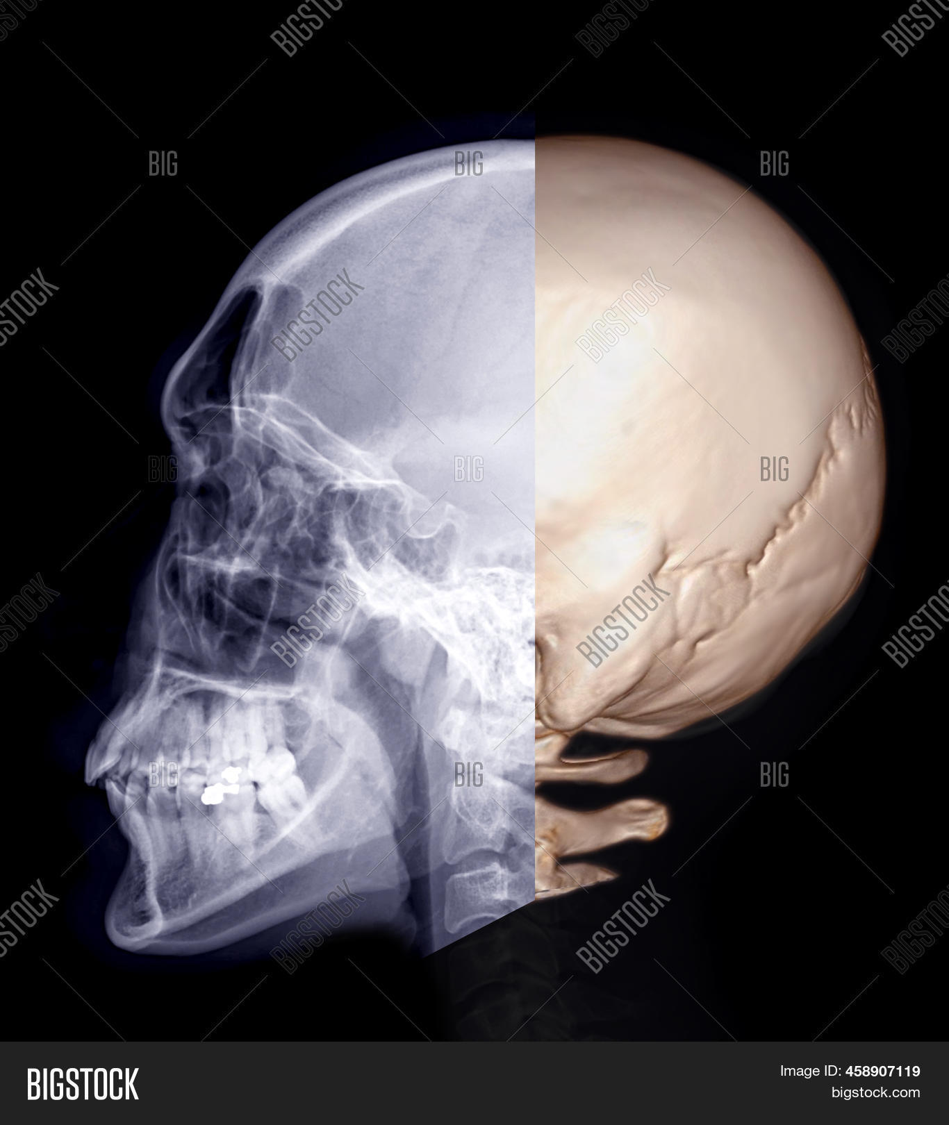 Skull X-ray Image Image & Photo (Free Trial) | Bigstock