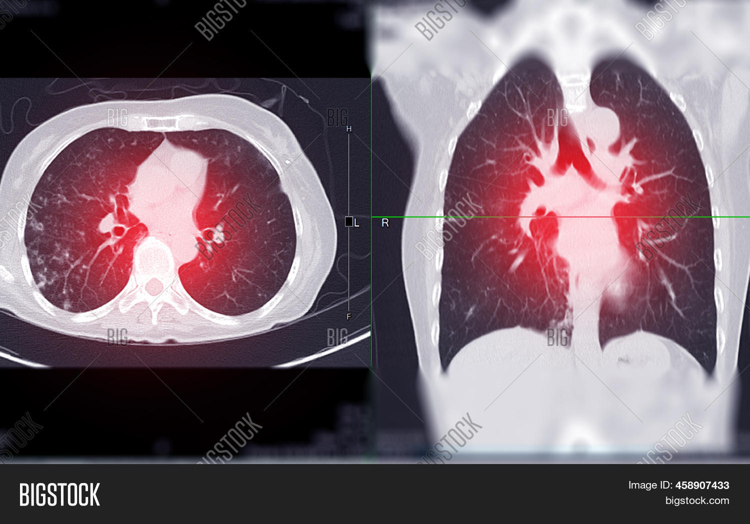 Ct Chest Ct Scan Lung Image & Photo (Free Trial) | Bigstock