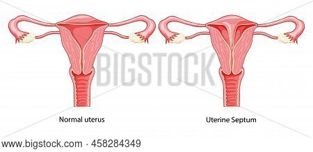 Set Uterine Septum Vector & Photo (Free Trial) | Bigstock