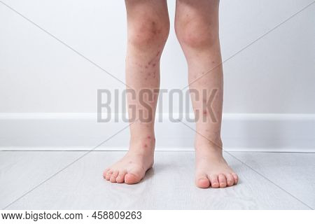 Chickenpox Disease, Image & Photo (Free Trial) | Bigstock