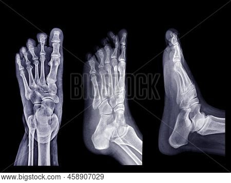 Collection Foot X-ray Image & Photo (Free Trial) | Bigstock