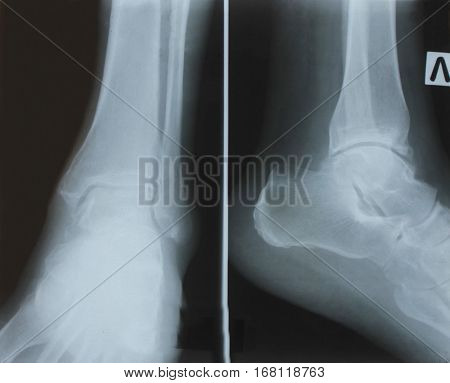 X-rays Ankle Joint Image & Photo (Free Trial) | Bigstock