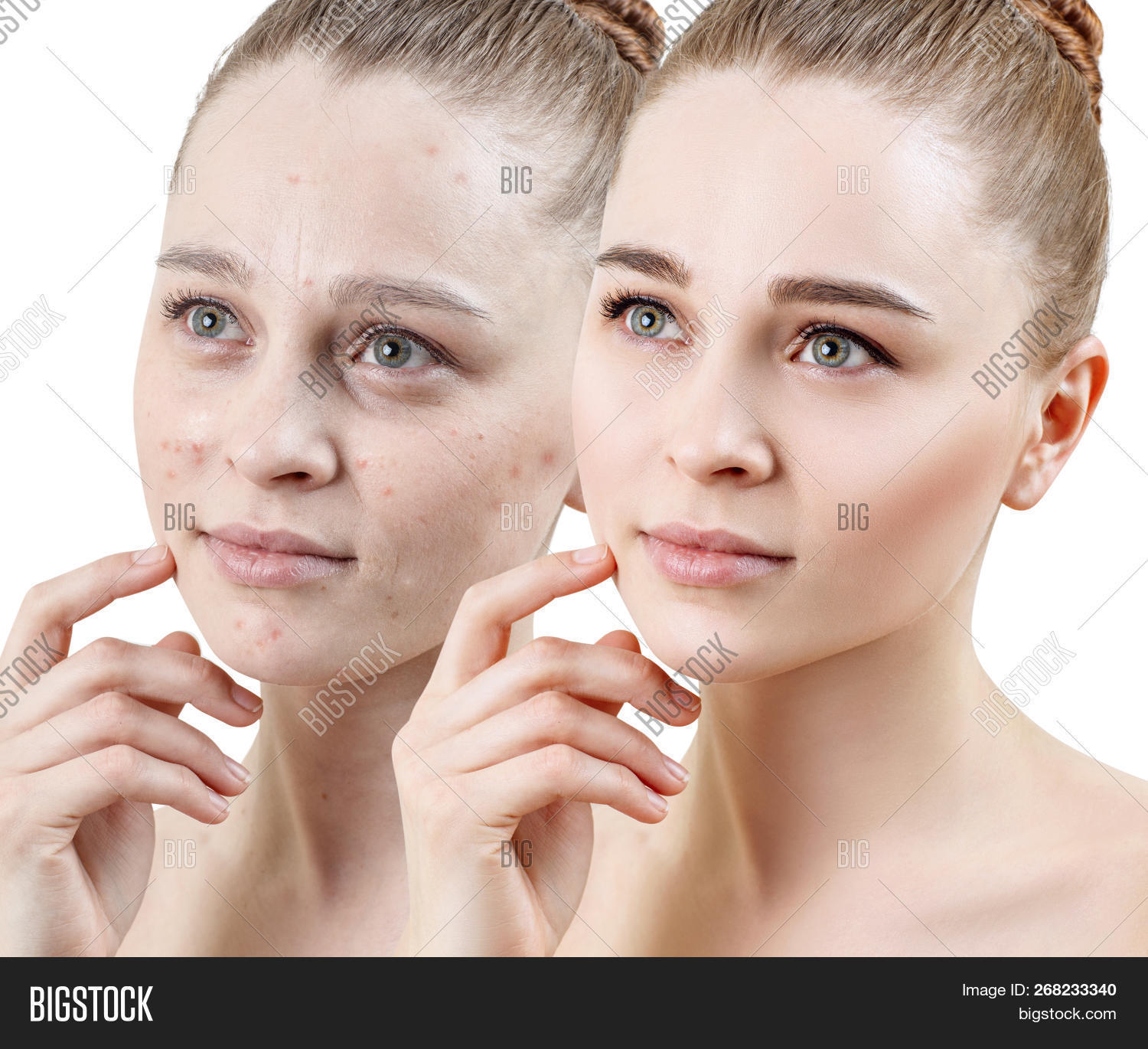 Woman Acne Before Image & Photo (Free Trial) | Bigstock