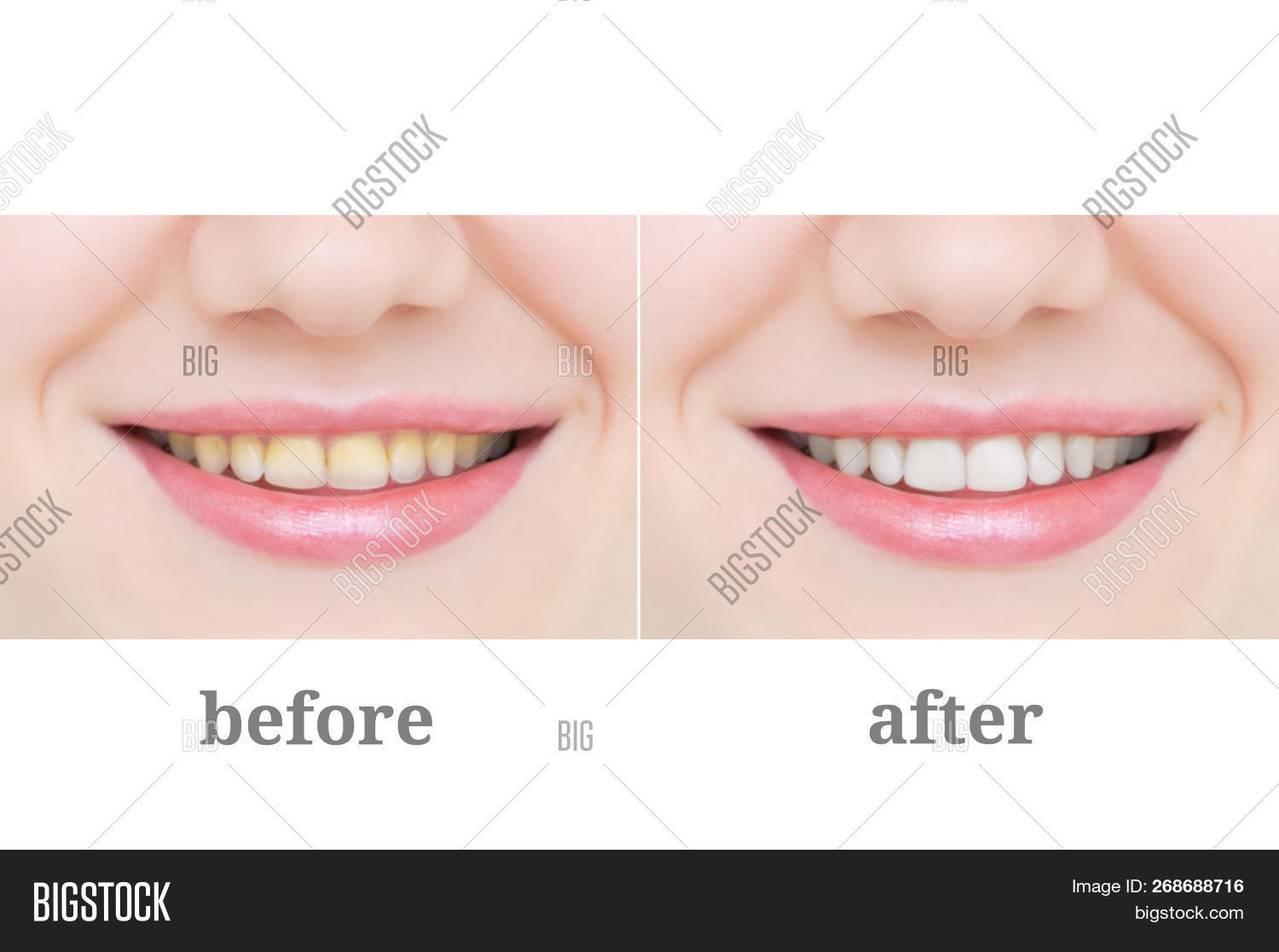 Teeth Yellow Coating Image & Photo (Free Trial) | Bigstock