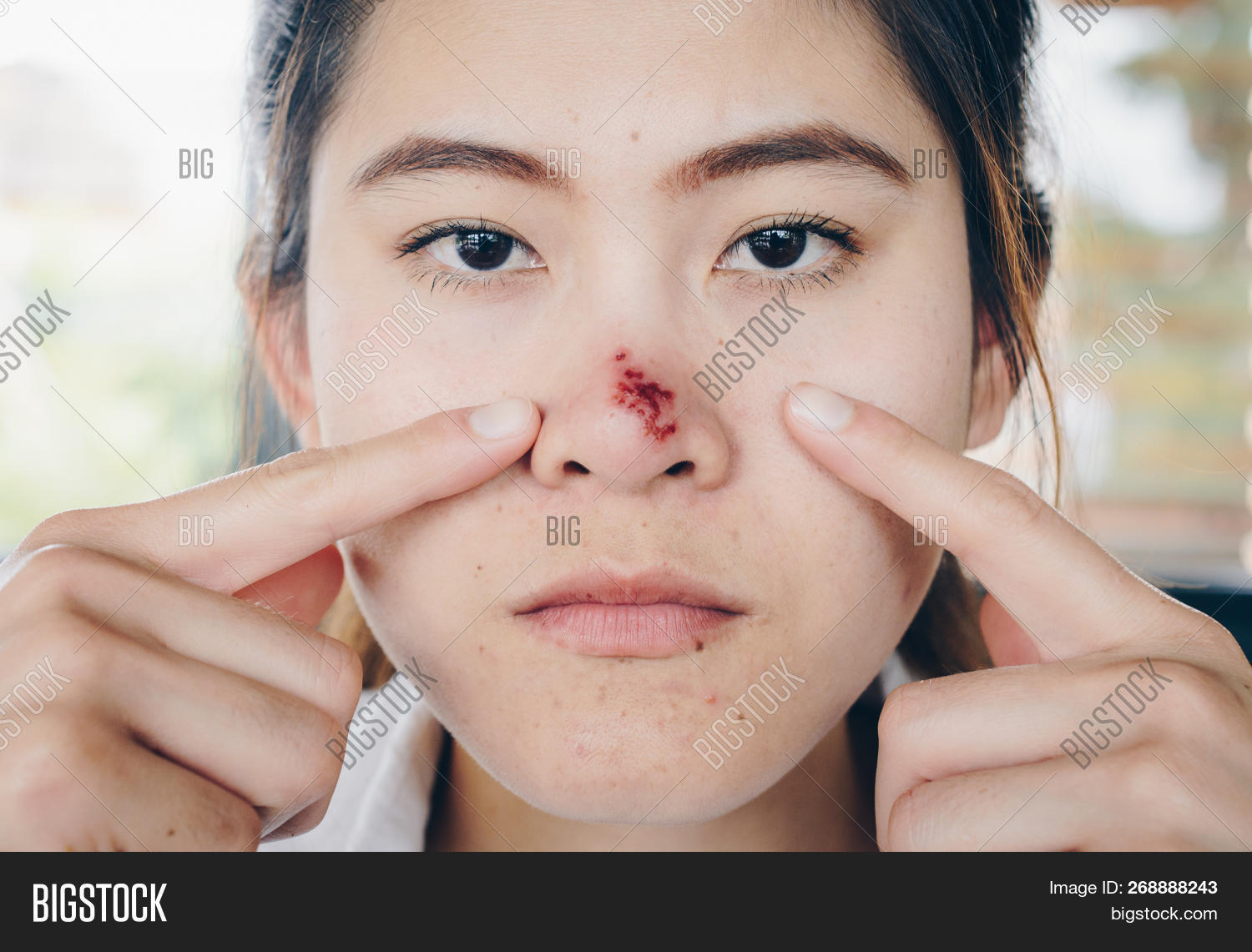 Herpes Simplex On Image & Photo (Free Trial) | Bigstock