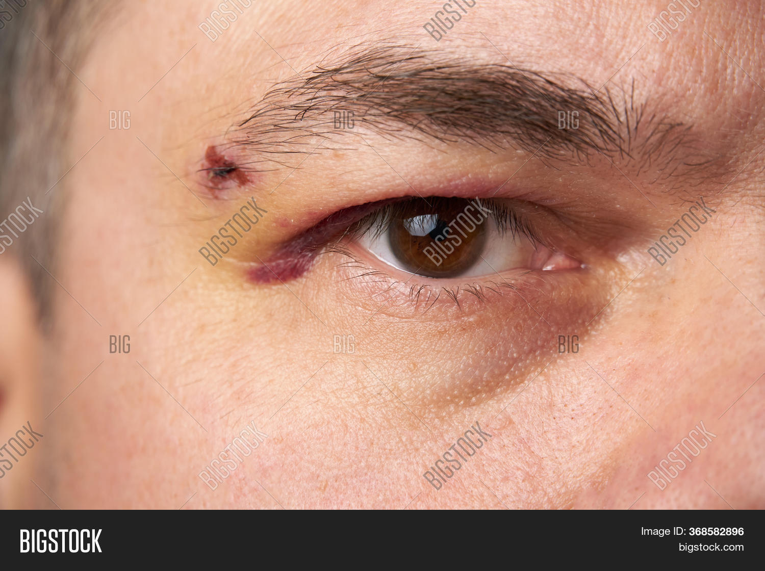 Close View Bruise Near Image & Photo (Free Trial) | Bigstock