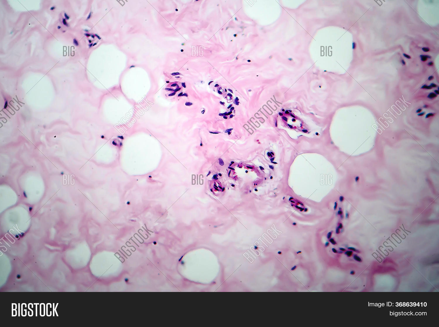 Breast Fibroadenosis, Image & Photo (Free Trial) | Bigstock