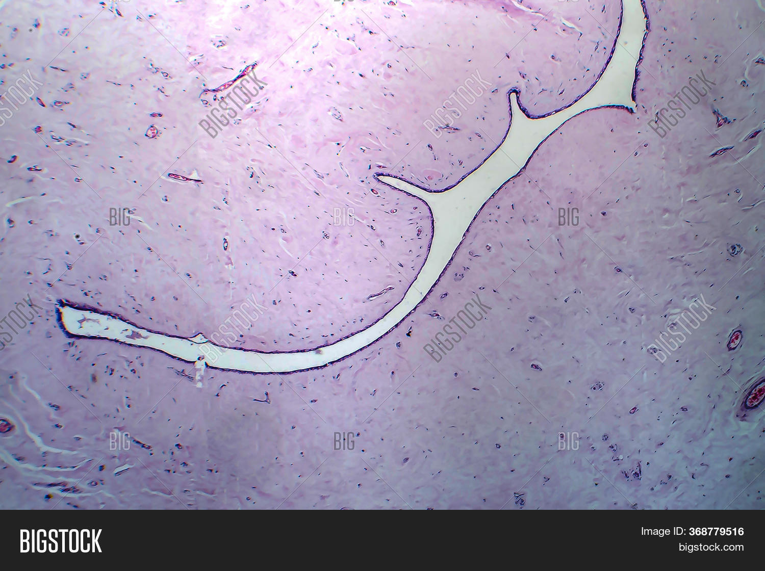 Uterus Adenofibroma, Image & Photo (Free Trial) | Bigstock