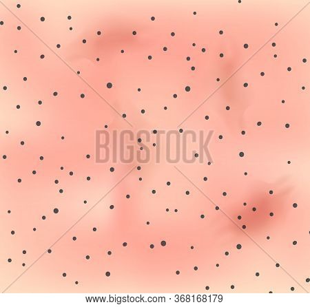 Open Comedones. Acne Image & Photo (Free Trial) | Bigstock