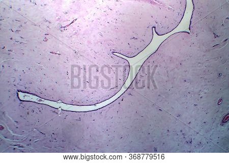 Uterus Adenofibroma, Image & Photo (Free Trial) | Bigstock