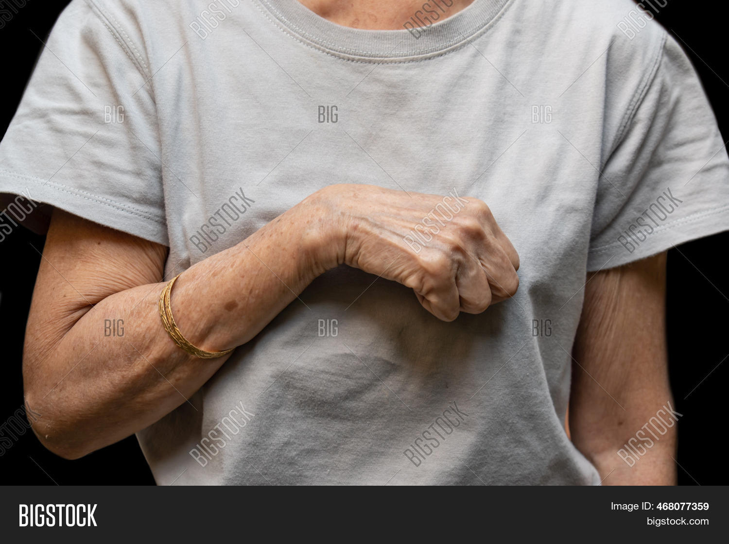 Volkmann Contracture Image & Photo (Free Trial) | Bigstock