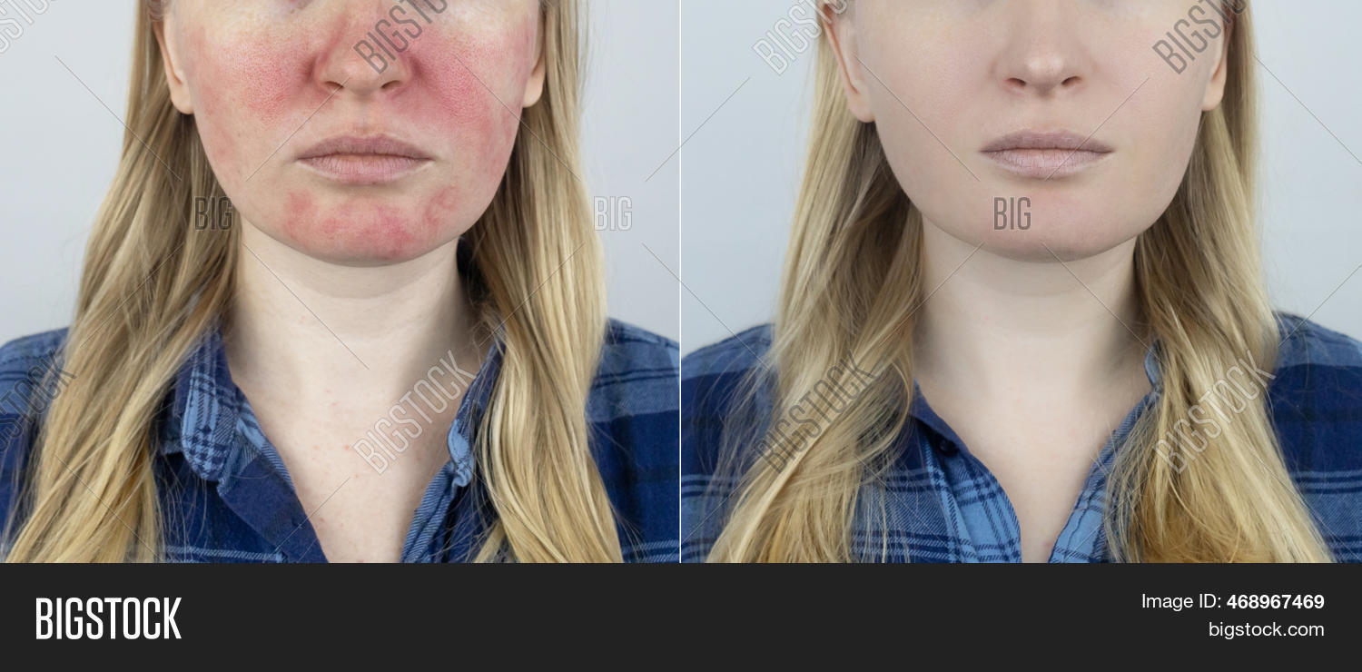 Rosacea Face. Girl Image & Photo (Free Trial) | Bigstock