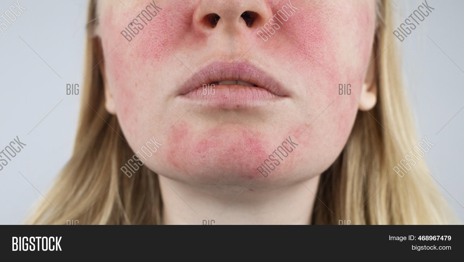 Rosacea Face. Girl Image & Photo (Free Trial) | Bigstock