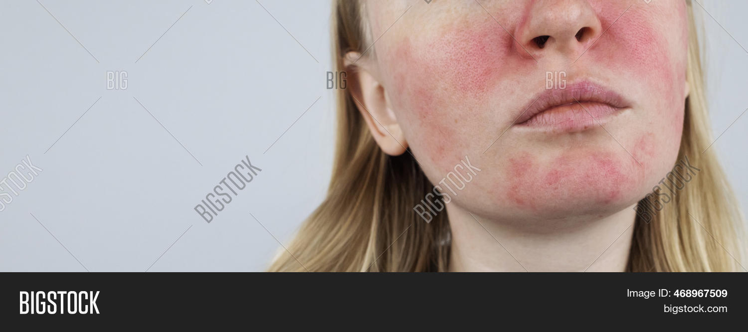 Rosacea Face. Girl Image & Photo (Free Trial) | Bigstock